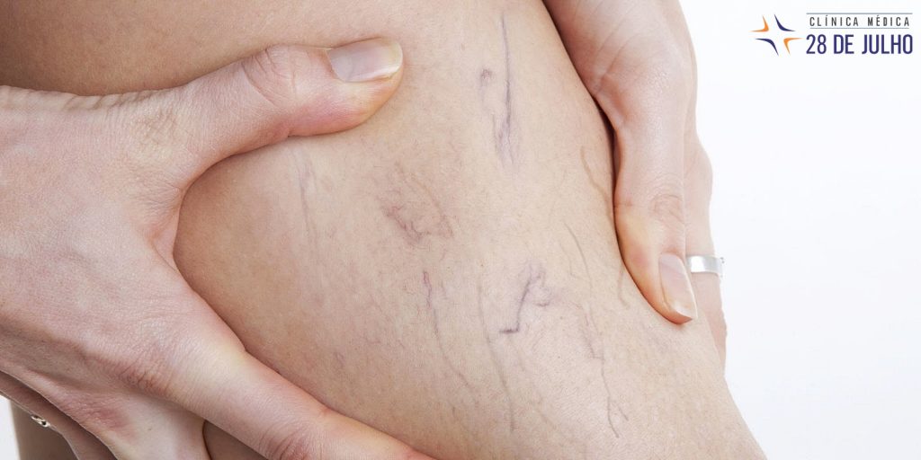 Varize: sintomas, tratamentos e causas